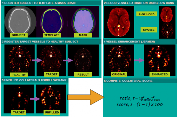 Computer Aided Diagnosis in Stroke – AP Lab